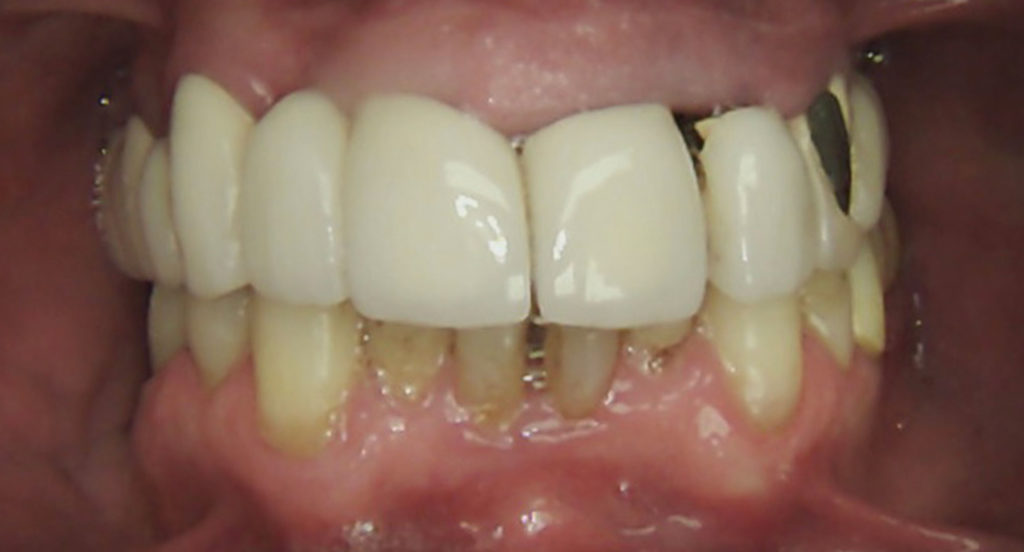 Full Arch Dental Implants - Durham Dental Solutions